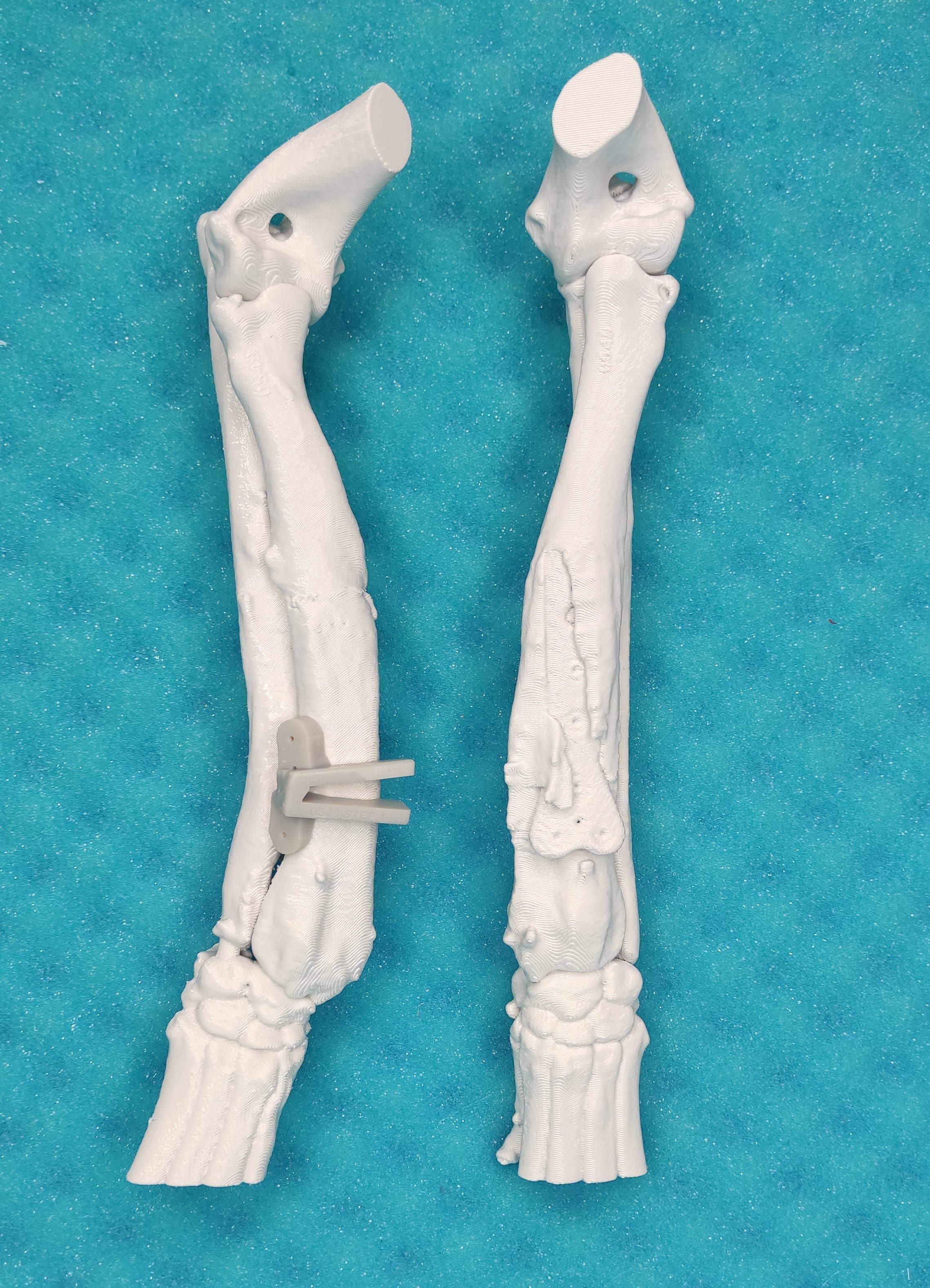 Custom-Made Drill and Sawblade Guides with Integrated CAD Surgery ...